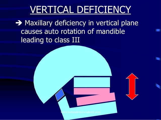 Protraction headgear for class 3 correction /certified fixed orthodon…
