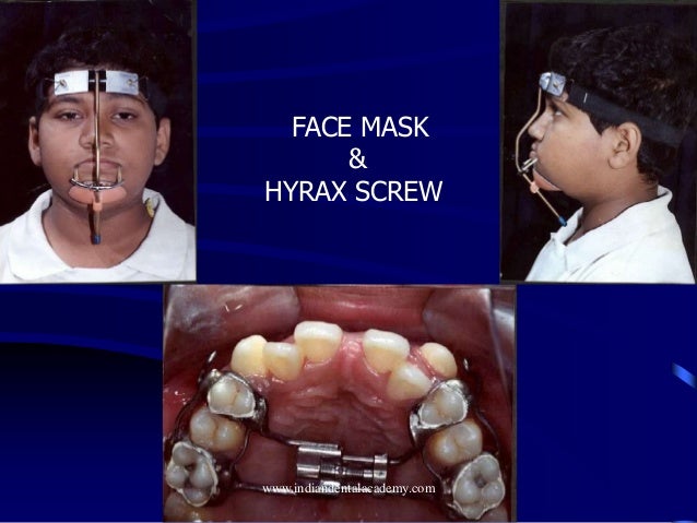 Protraction headgear for class 3 correction /certified fixed orthodon…