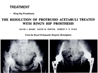 Protrusio acetabuli | PPTX