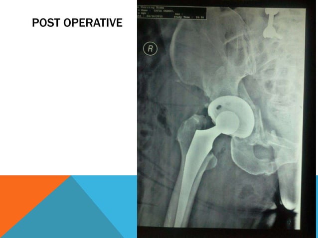 Protrusio acetabuli | PPTX