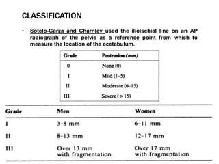 Protrusio acetabuli | PPTX