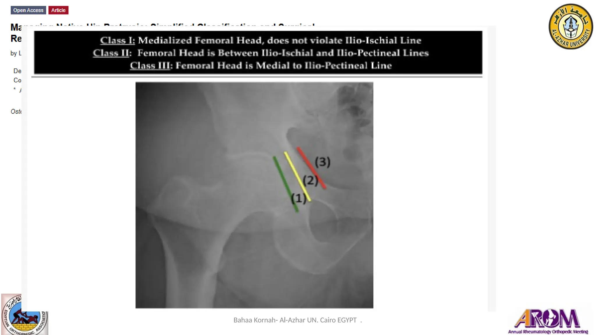 Protrusio Acetabuli -Acetabular protrusion - Otto pelvisi.pptx