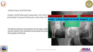 Protrusio Acetabuli -Acetabular protrusion - Otto pelvisi.pptx