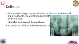 Protrusio Acetabuli -Acetabular protrusion - Otto pelvisi.pptx
