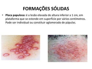 Prova 1 - dermatologia (lesões elementares, semiologia, exames e sinais ...