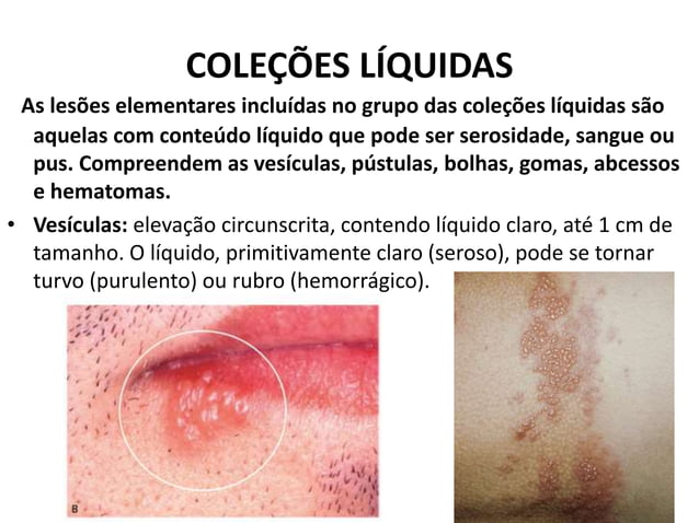 Prova 1 - dermatologia (lesões elementares, semiologia, exames e sinais)