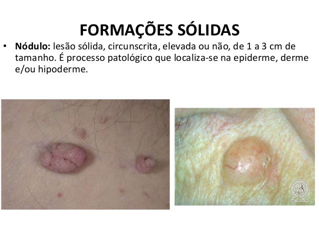 Prova 1 - dermatologia (lesões elementares, semiologia, exames e sina…