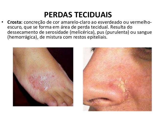 Prova 1 - dermatologia (lesões elementares, semiologia, exames e sina…