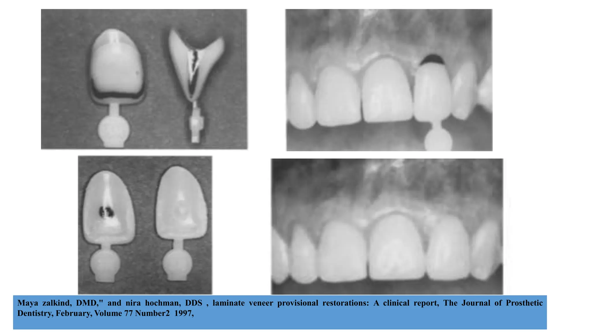 provisional restoration fixed partial denture | PPTX