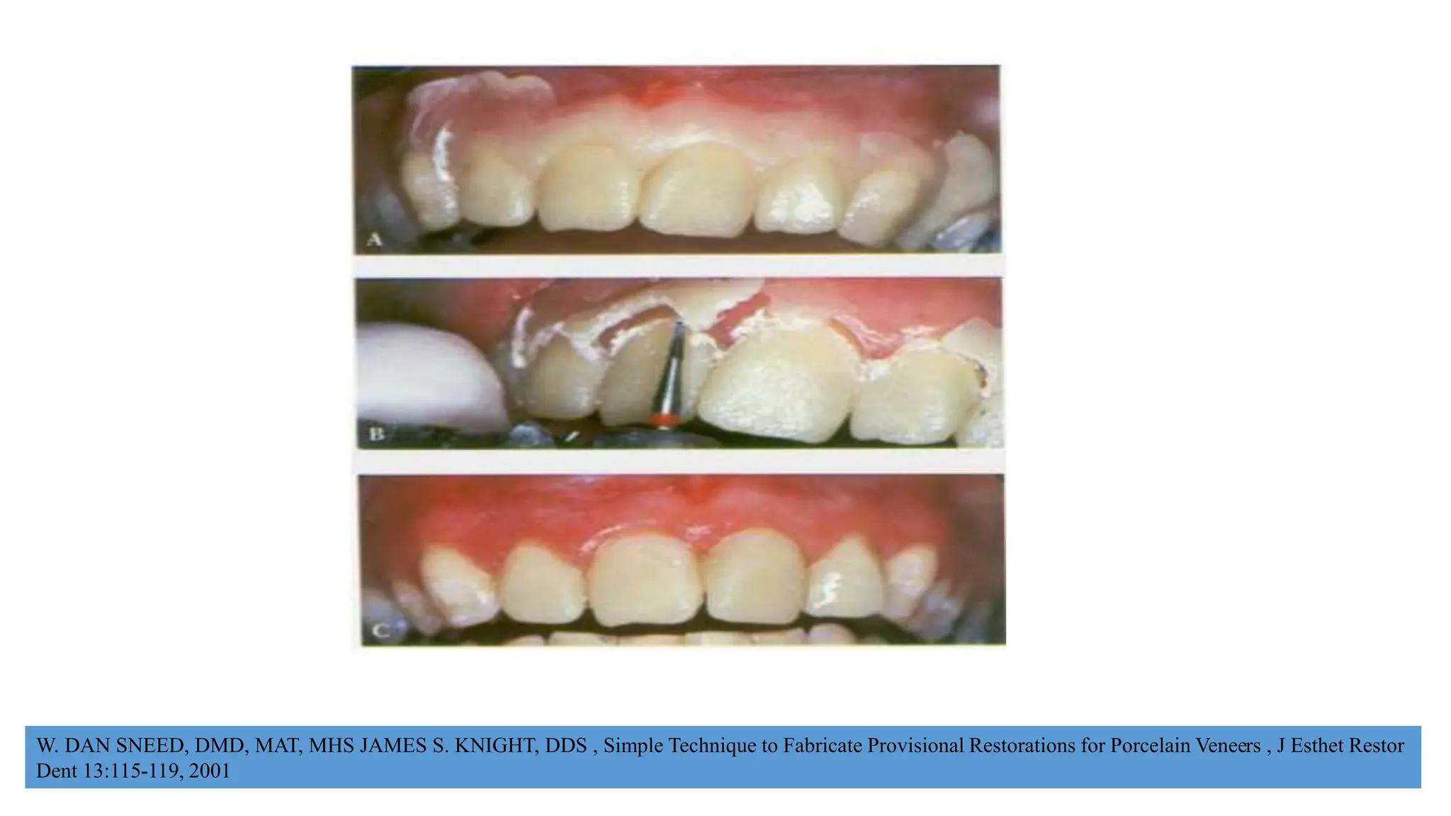 provisional restoration fixed partial denture | PPTX
