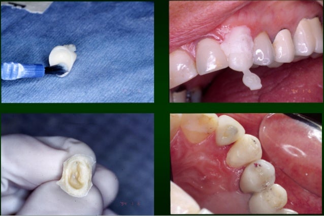 Provisional restoration