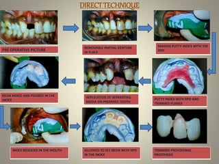 Provisional restoration | PPTX