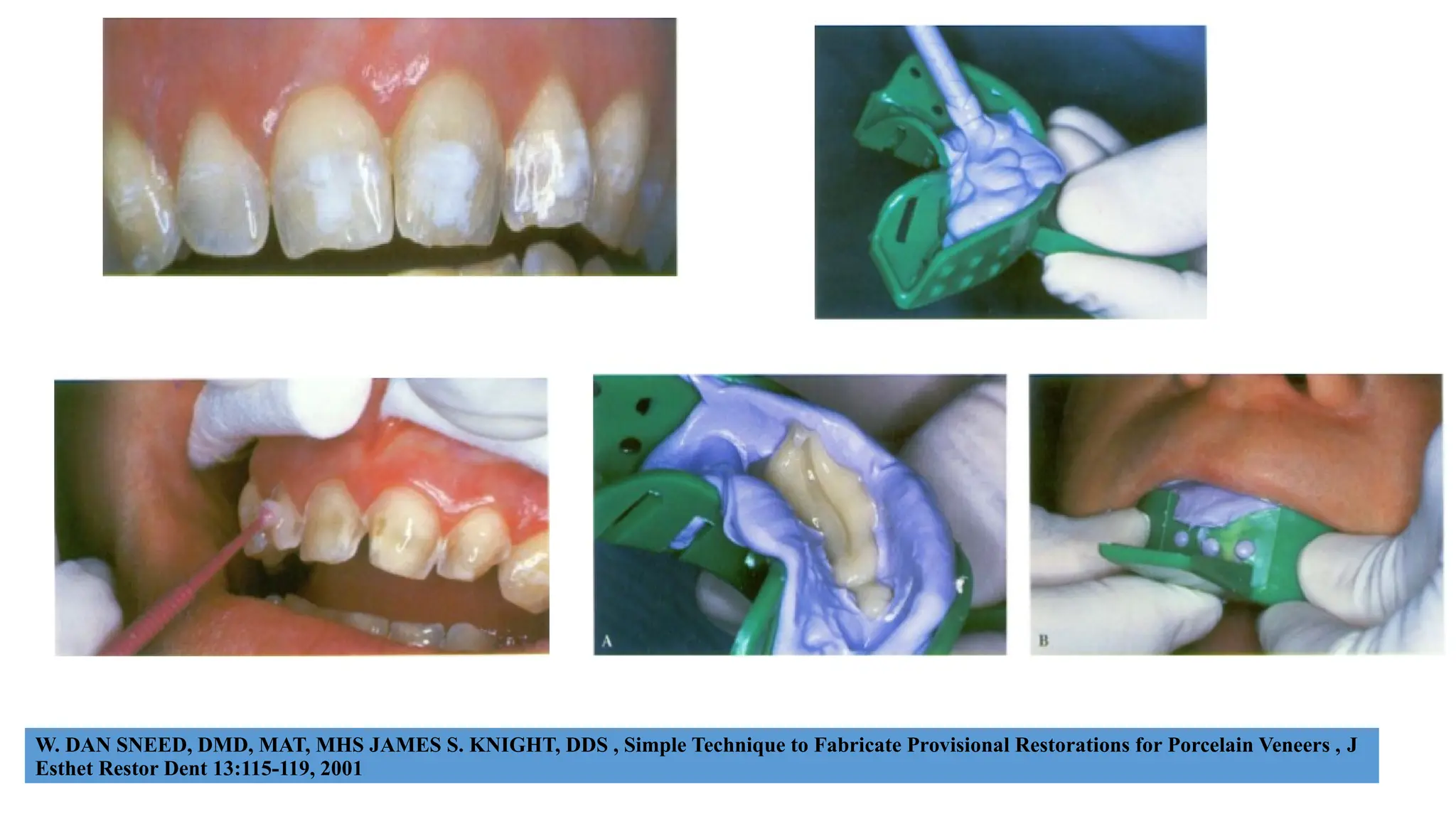 provisional restoration in fixed partial dentures.pptx | Dental Health | Diseases and Conditions