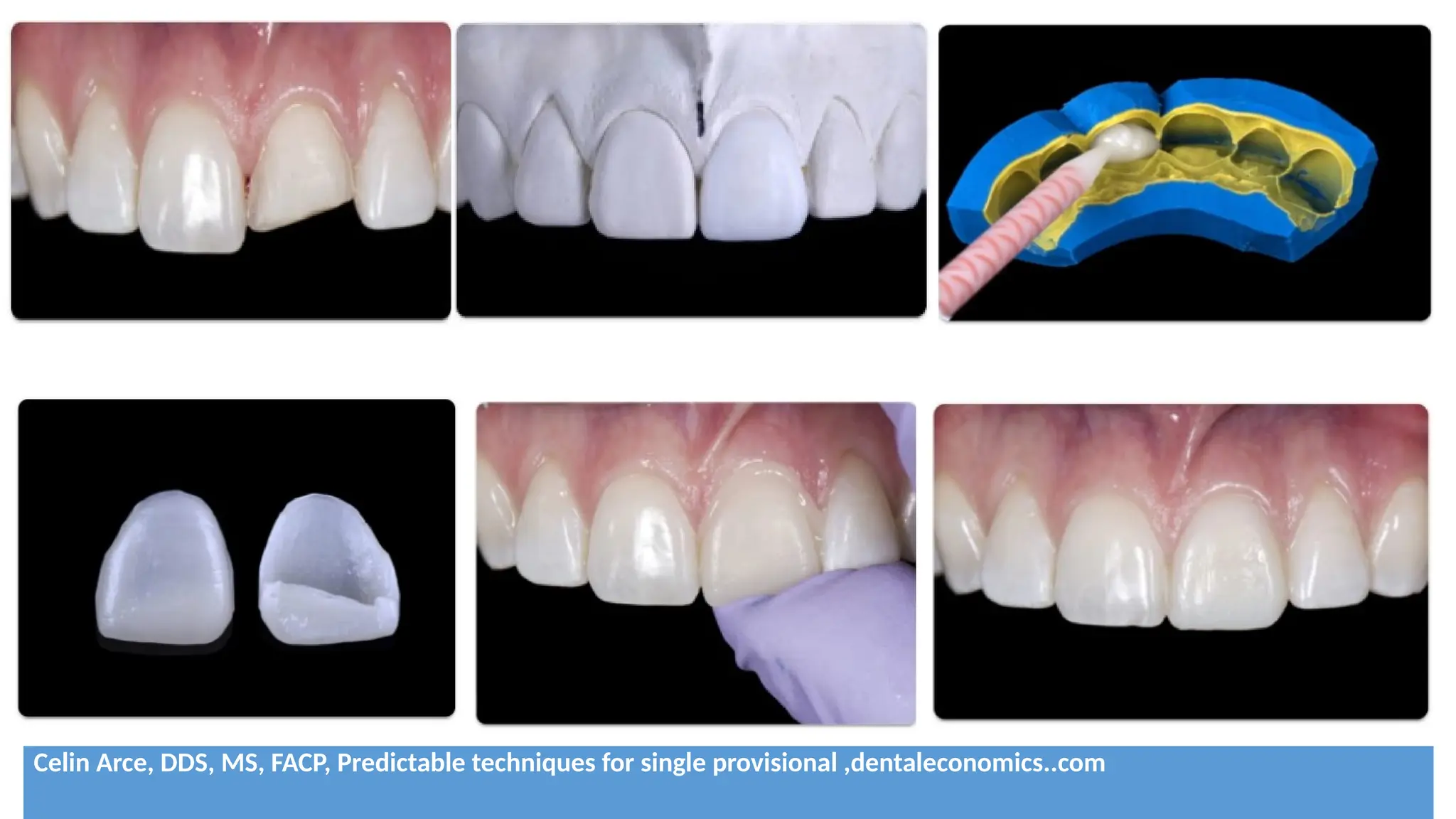 provisional restoration in fixed partial dentures.pptx | Dental Health | Diseases and Conditions