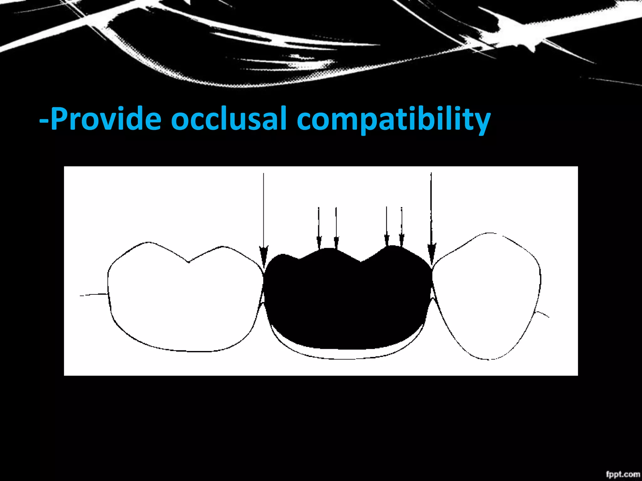 Provisional restoration in fixed partial denture | PPTX