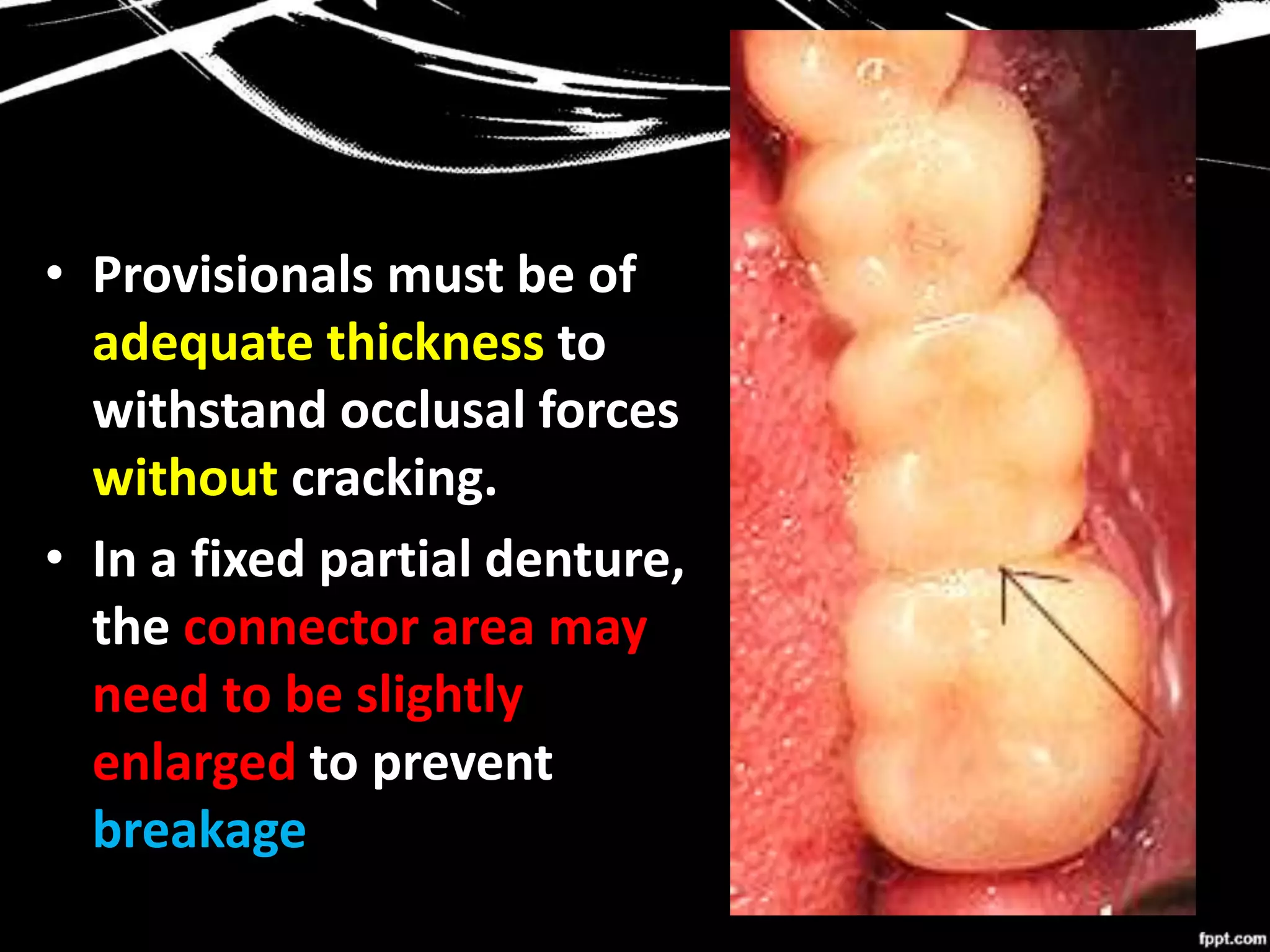 Provisional restoration in fixed partial denture | PPTX