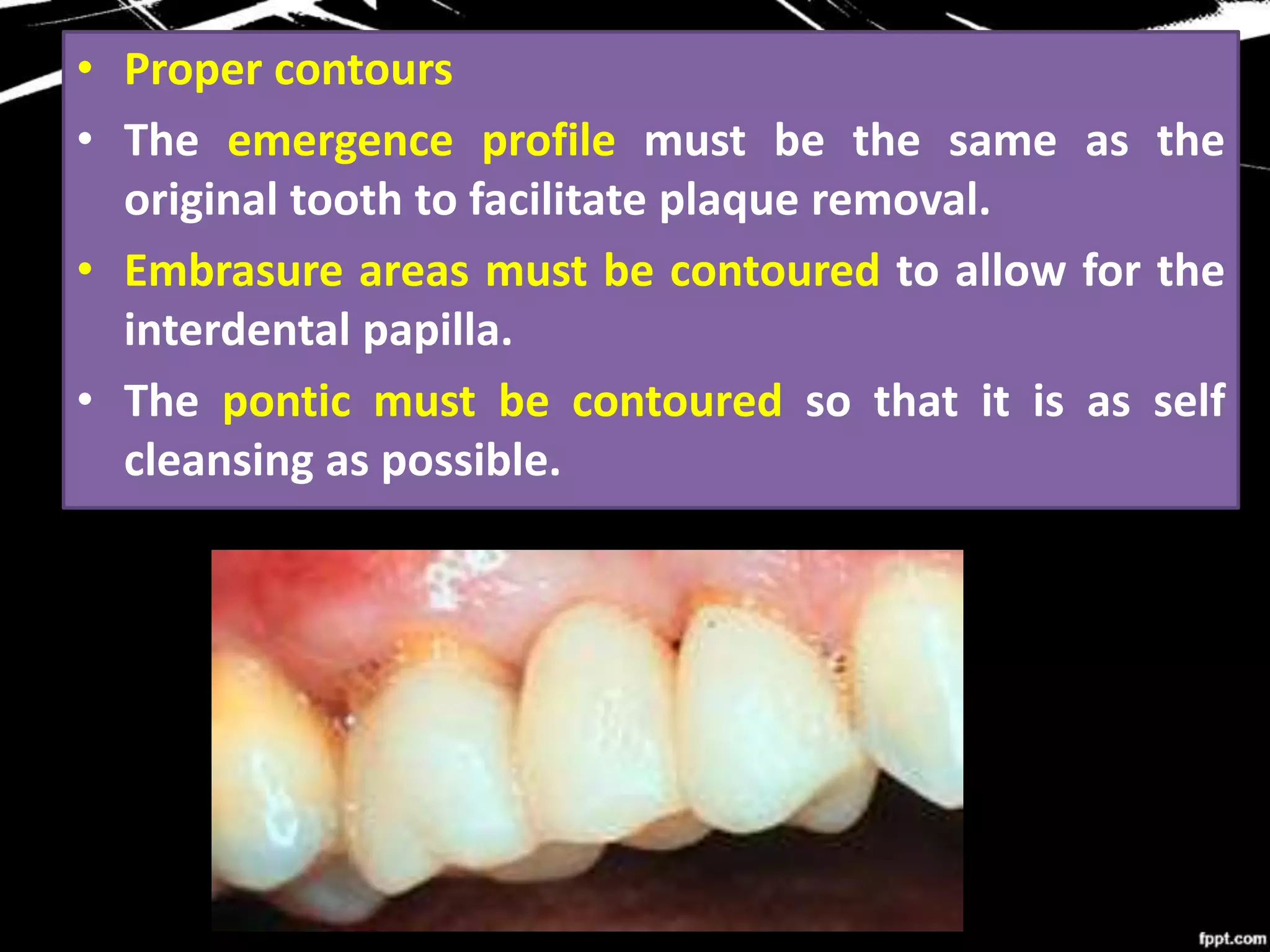 Provisional restoration in fixed partial denture | PPTX