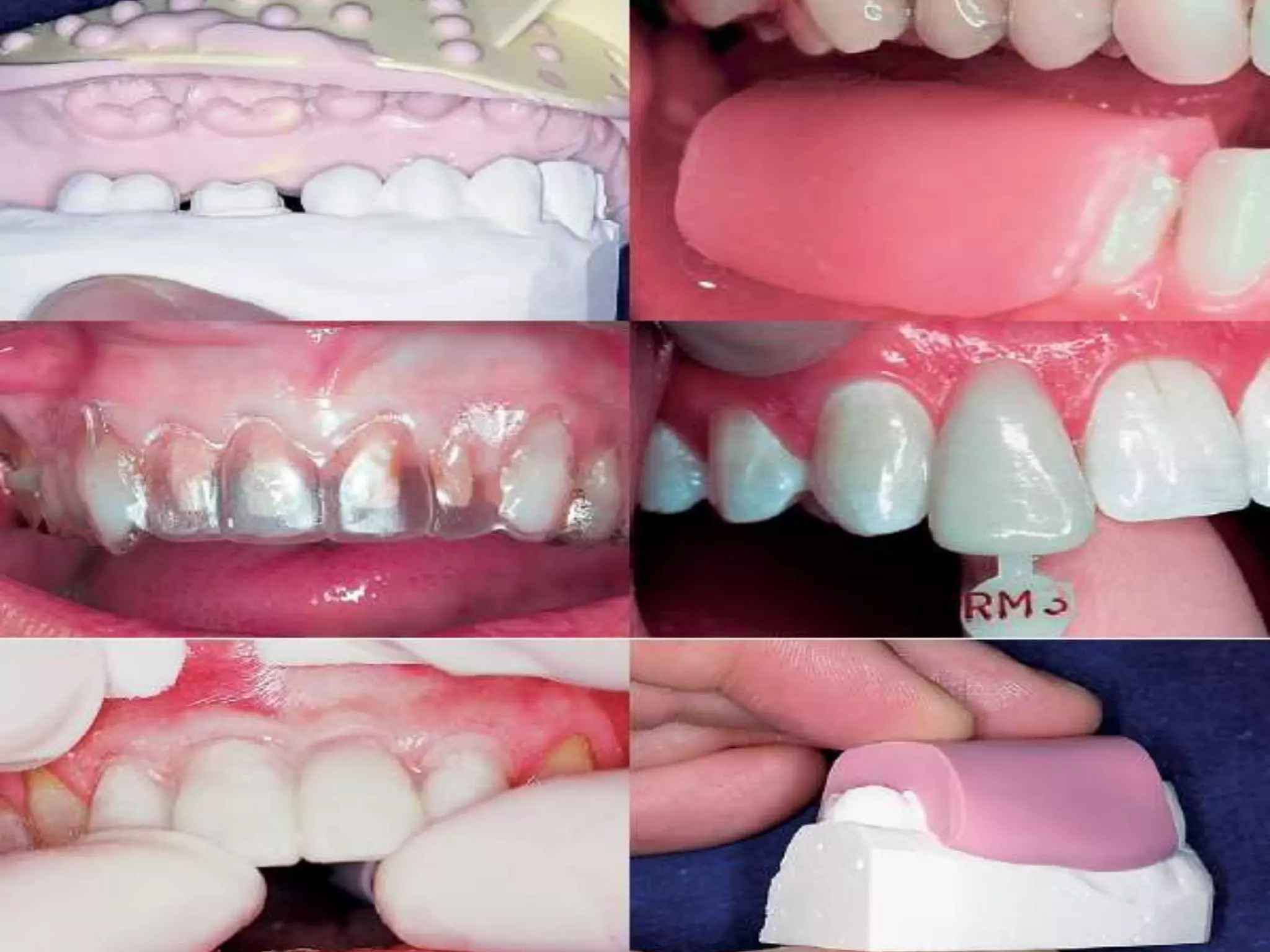 Provisional restoration in fixed partial denture | PPTX