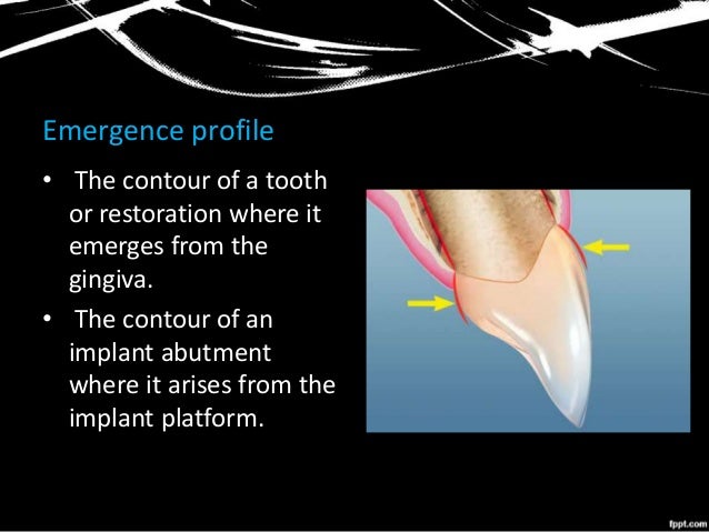 Provisional restoration in fixed partial denture