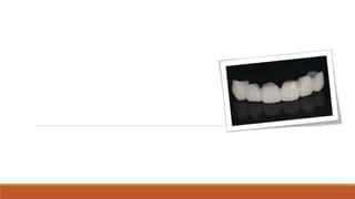 Provisional restorations in fixed partial denture | PPT