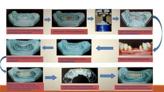Provisional restorations in fixed partial denture | PPT