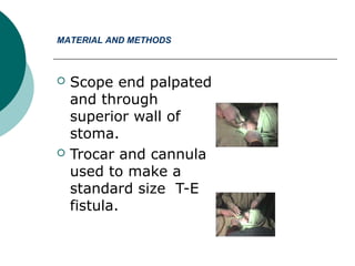 Provox voice prosthesis implantation. | PPT