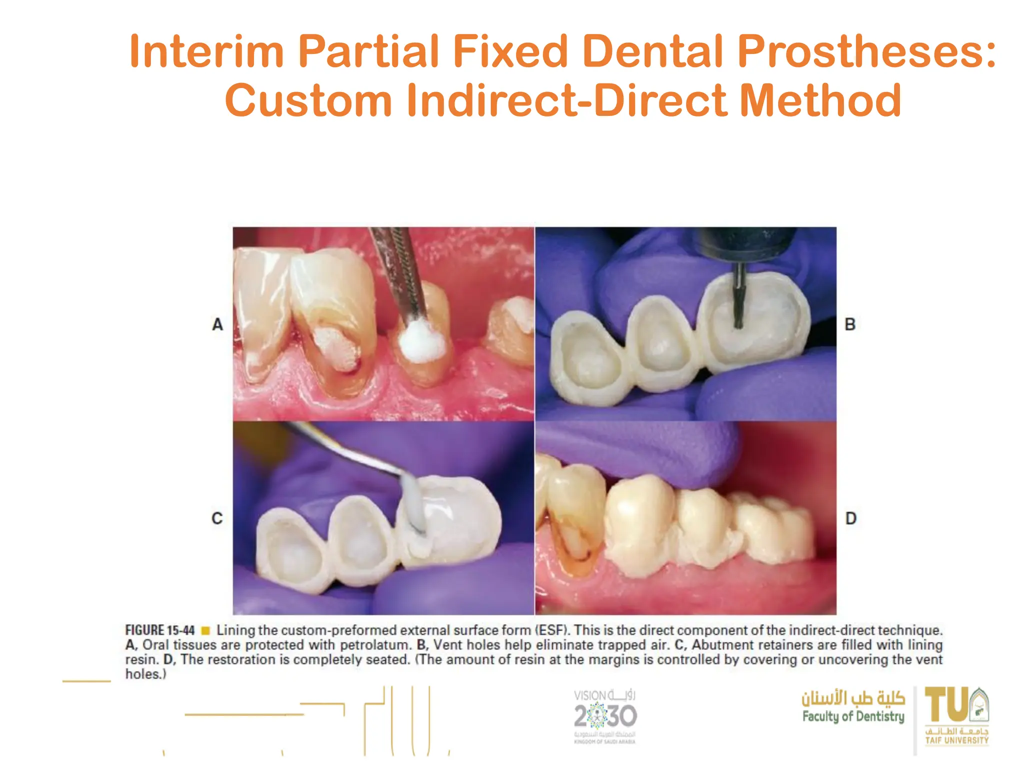provisional restoration in fixed taif.pdf