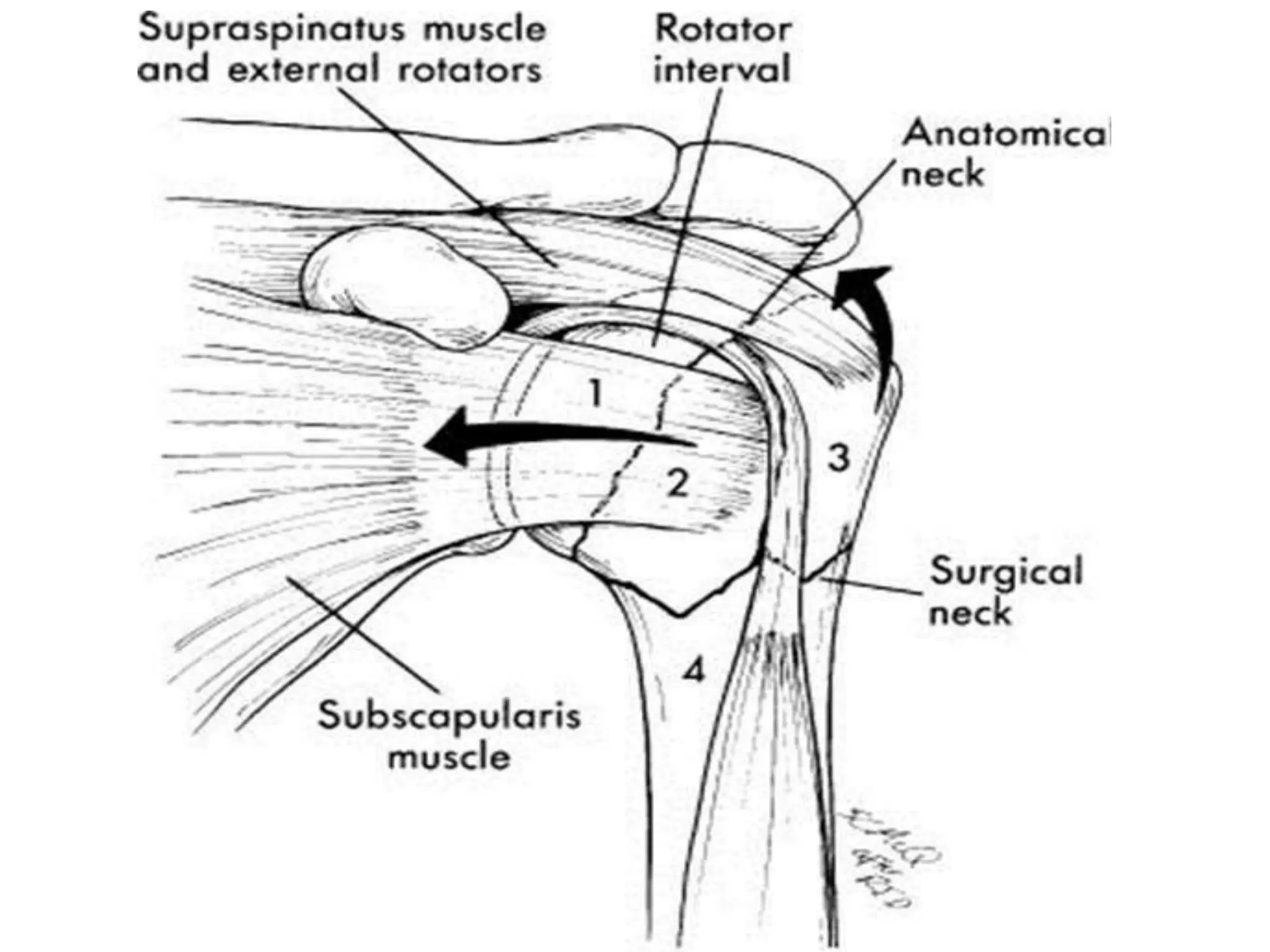 Proximal Humerus Fractures Ppt
