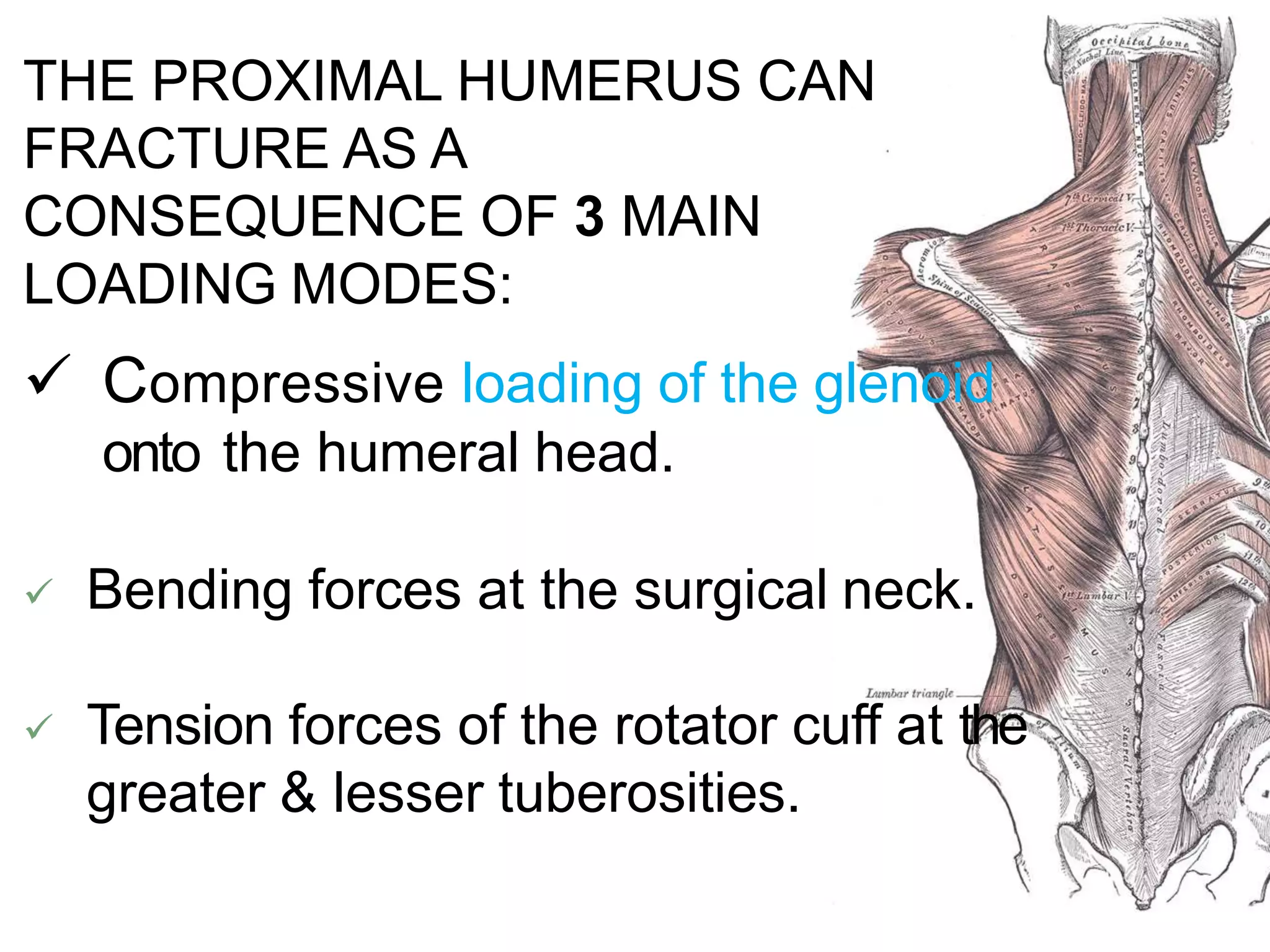 Proximal humerus fractures | PPTX