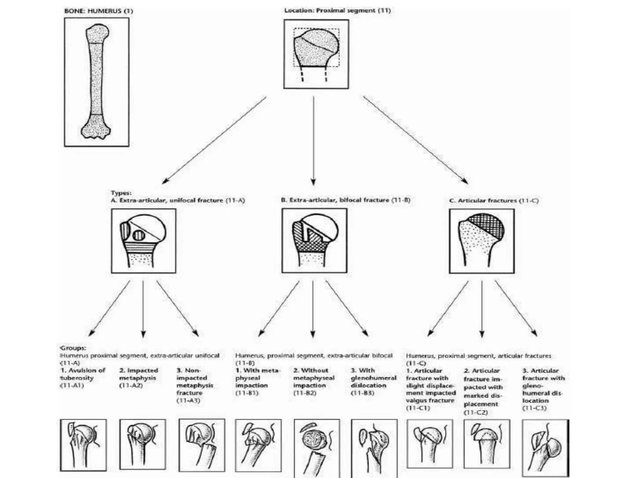 Proximal humerus fractures | PPTX