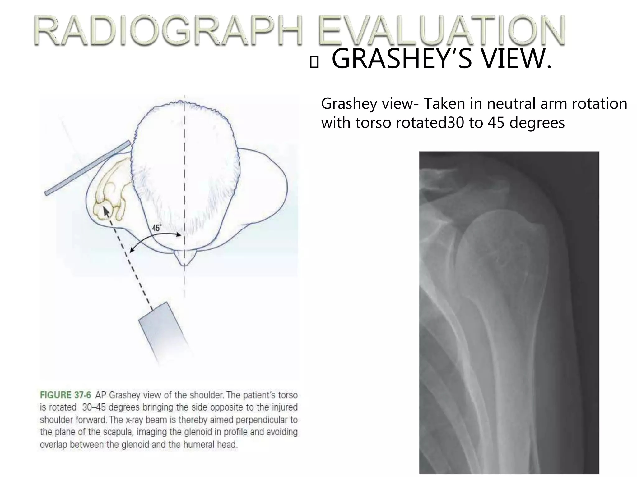 Proximal humerus fractures | PPTX
