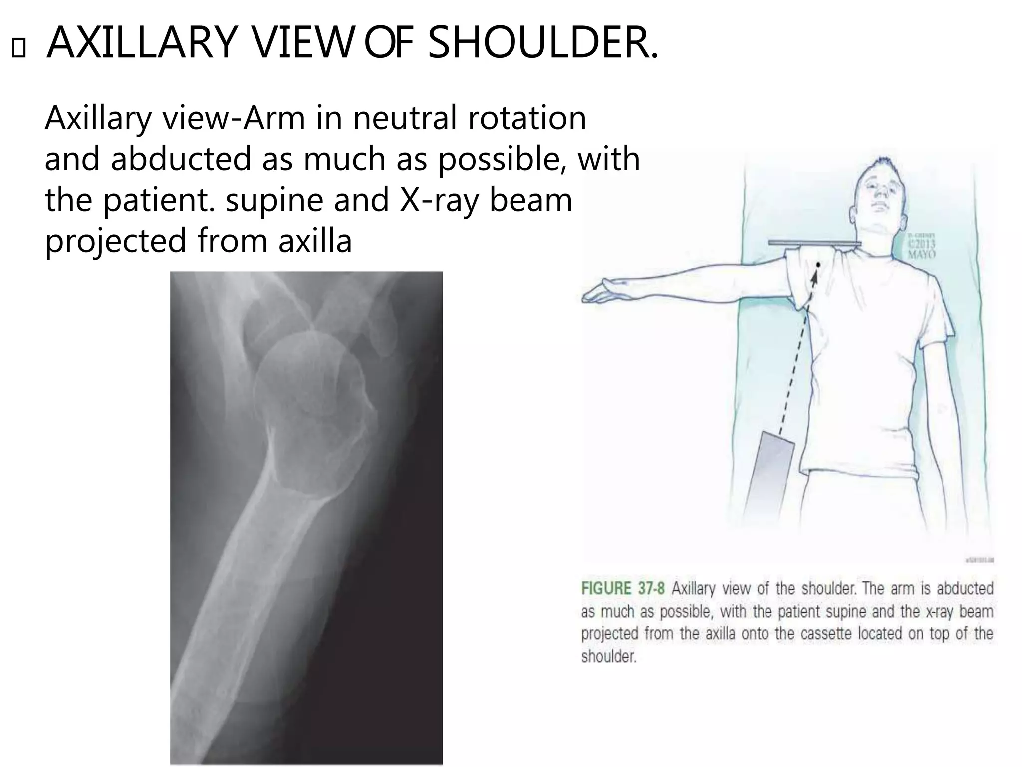 Proximal humerus fractures | PPTX