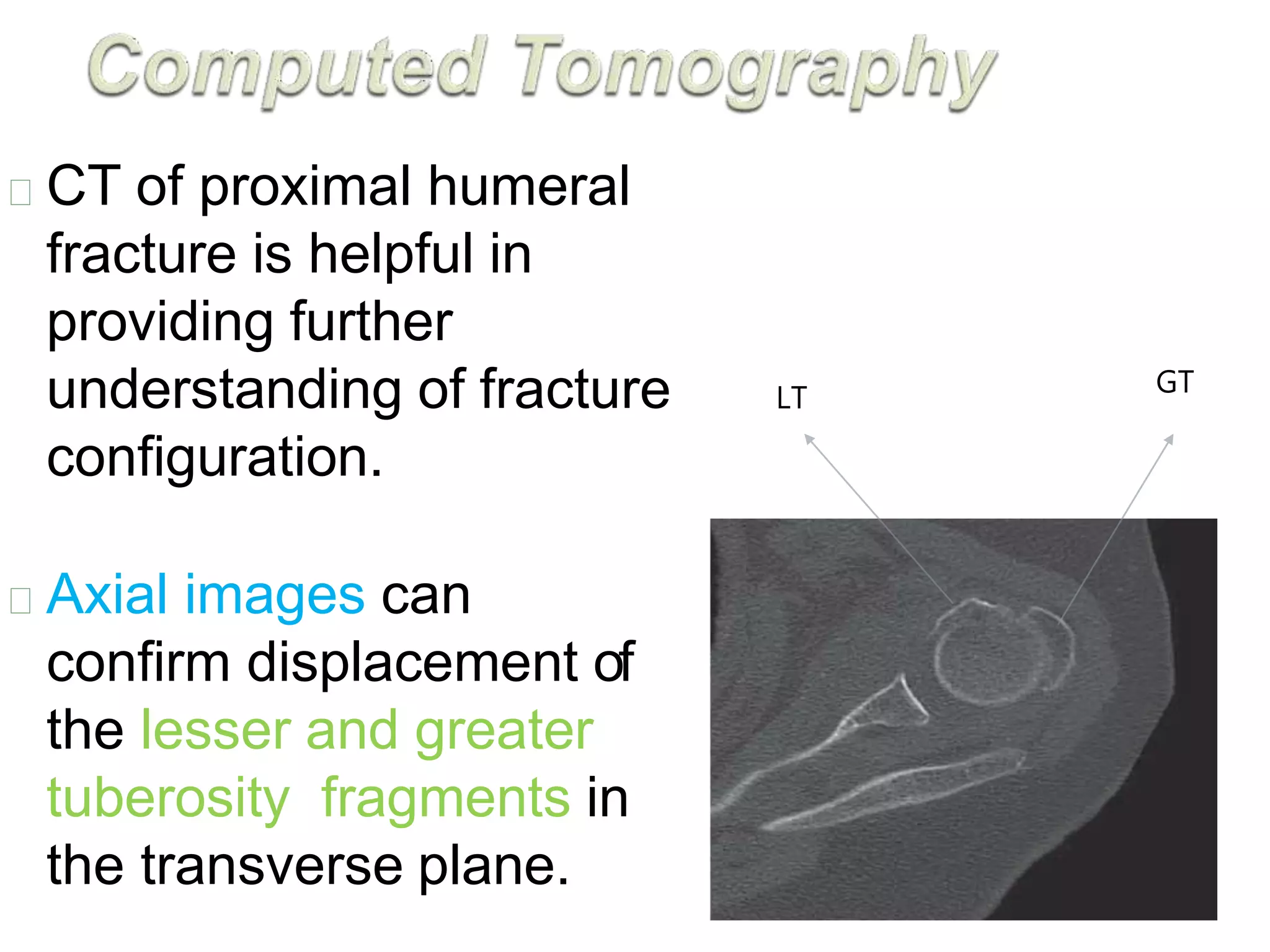 Proximal humerus fractures | PPTX