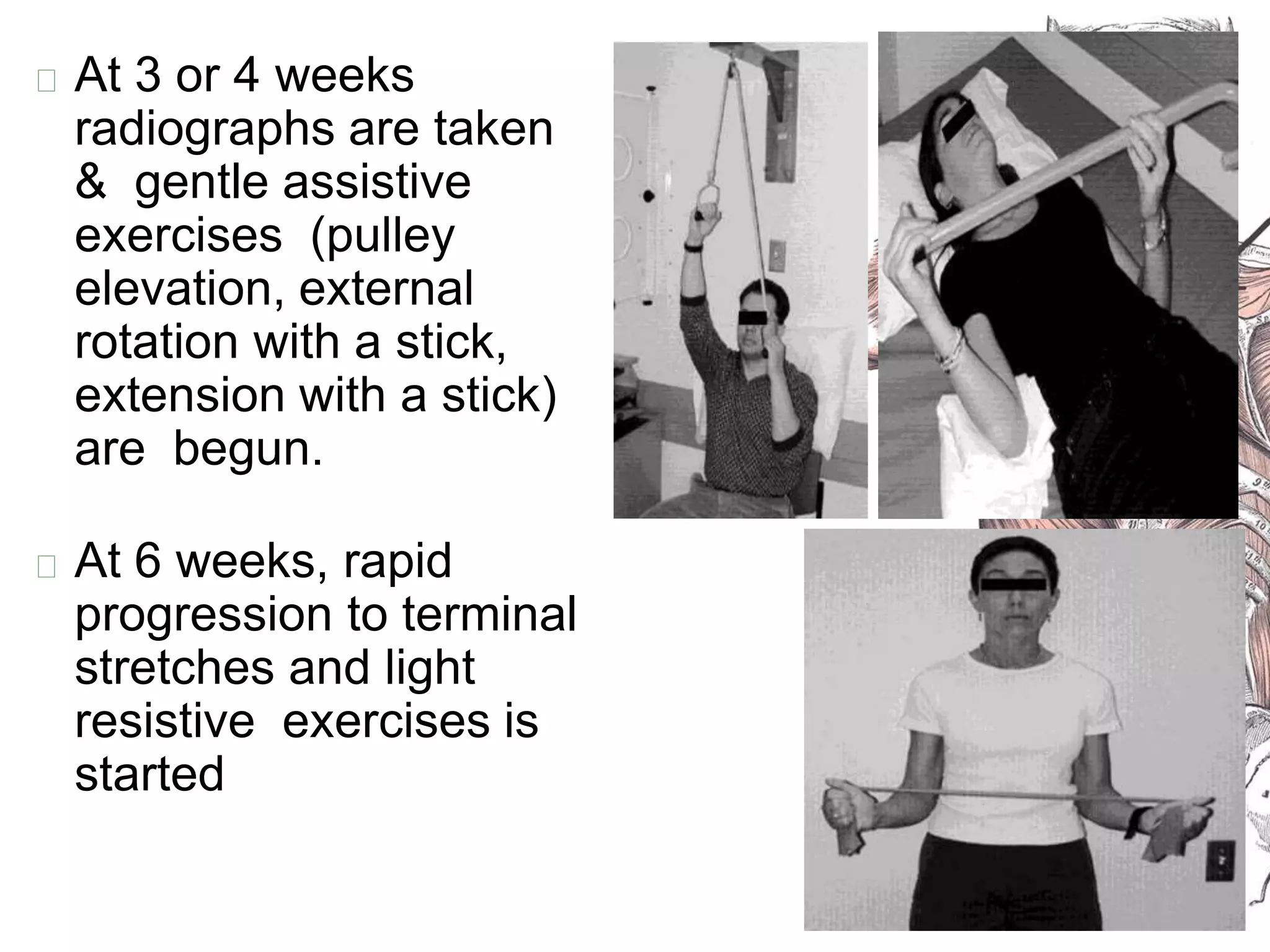 Proximal humerus fractures | PPTX