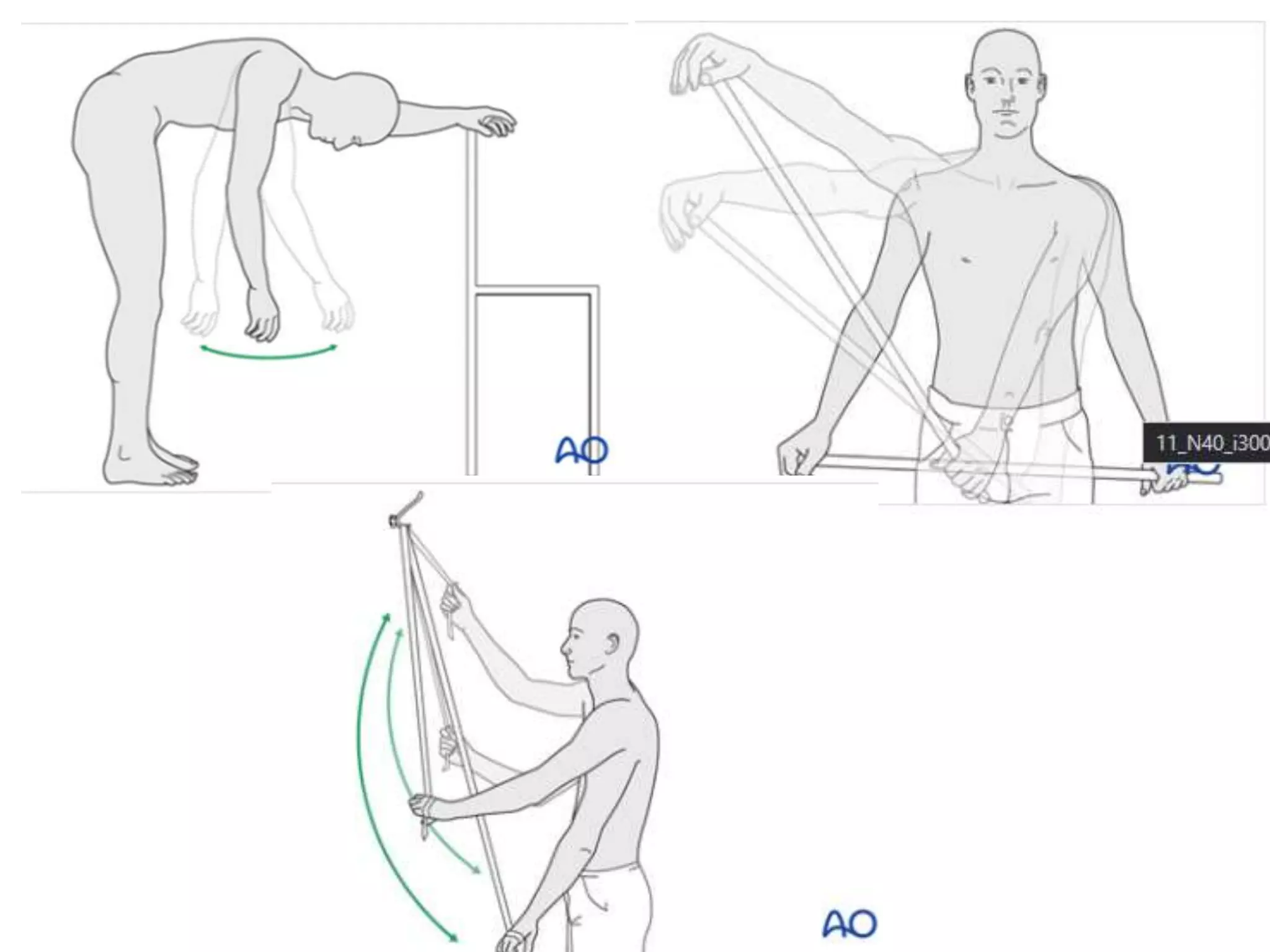 Proximal humerus fractures | PPTX