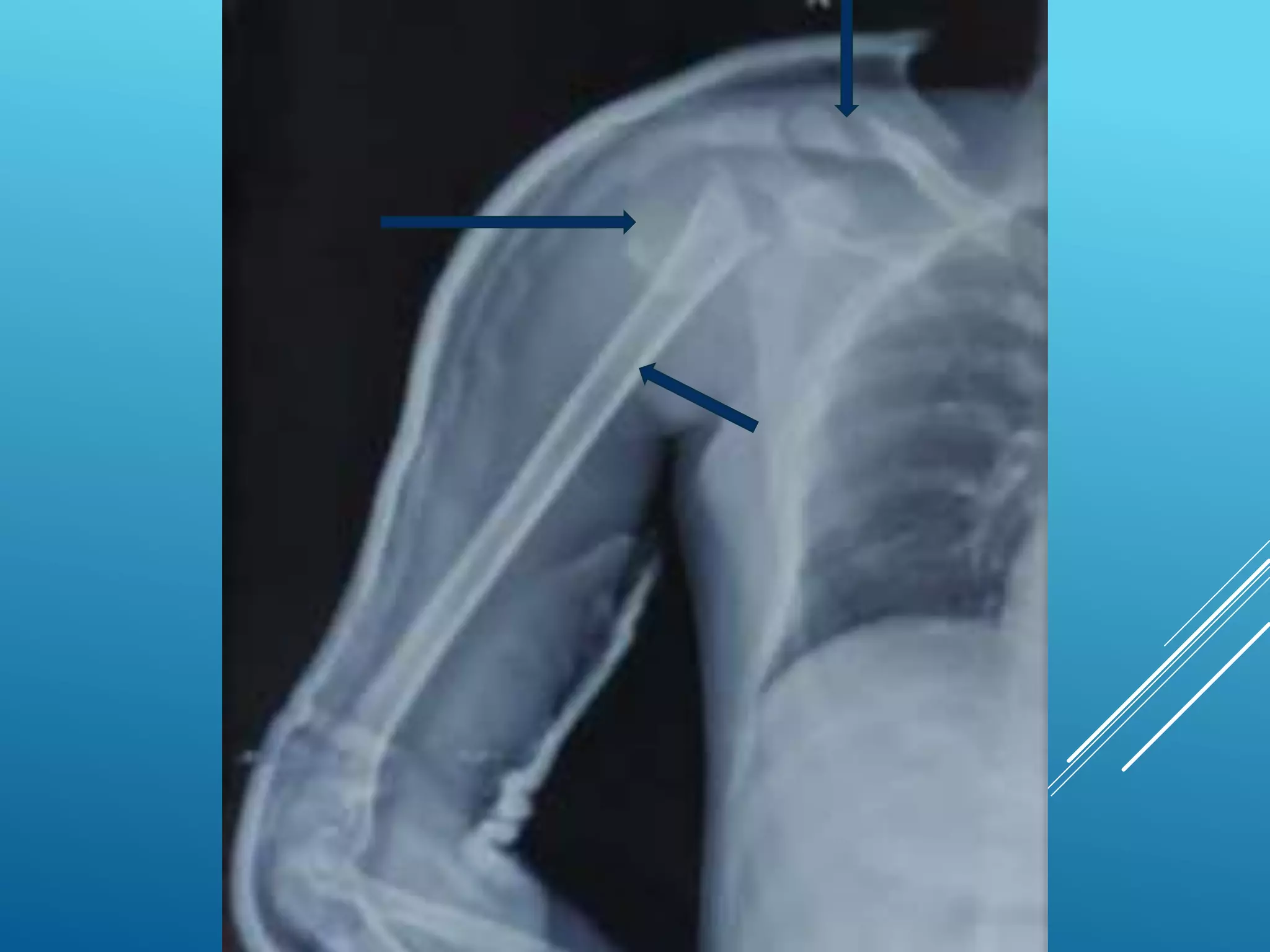 Proximal humerus fractures | PPTX