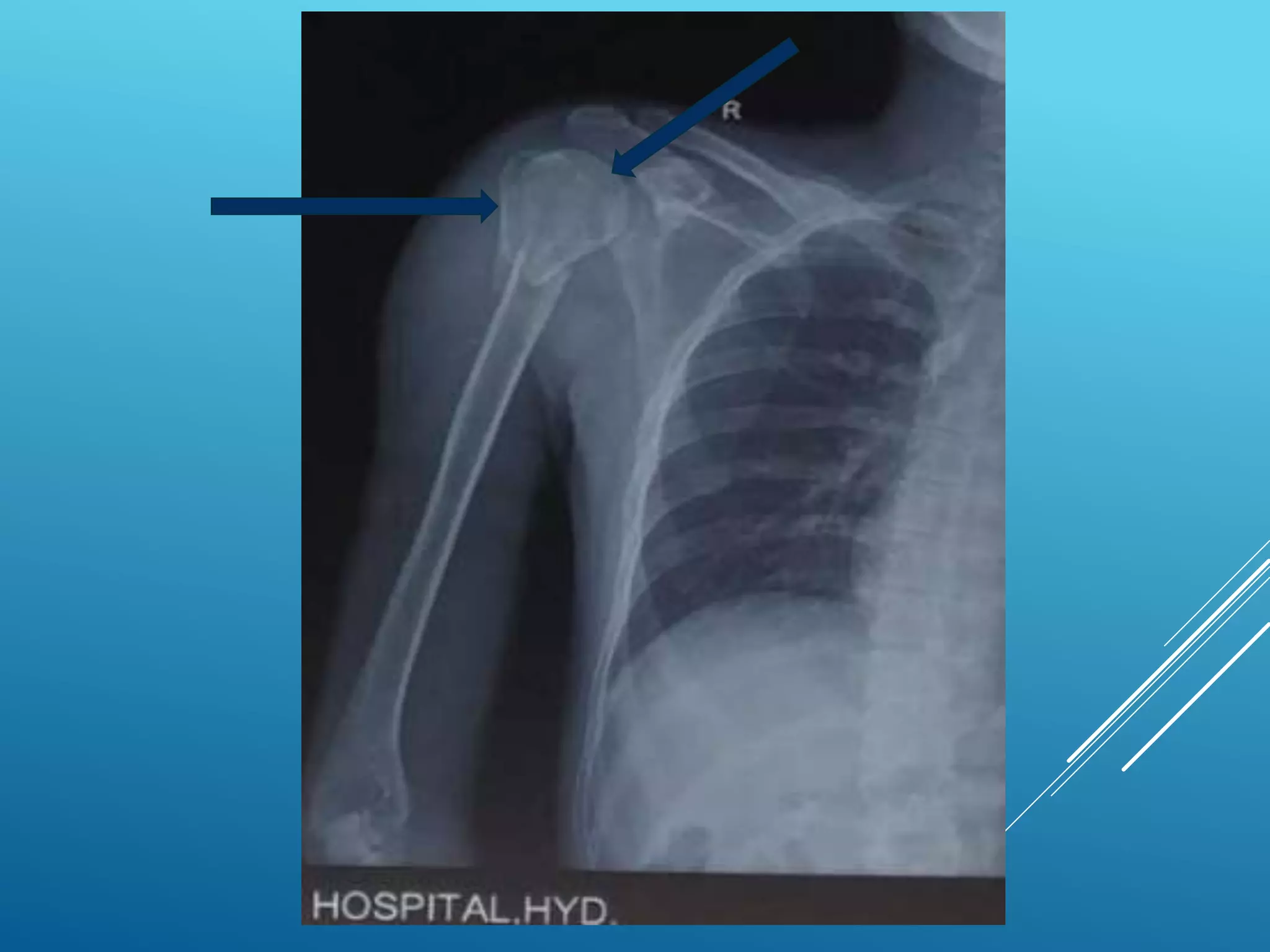 Proximal humerus fractures | PPT