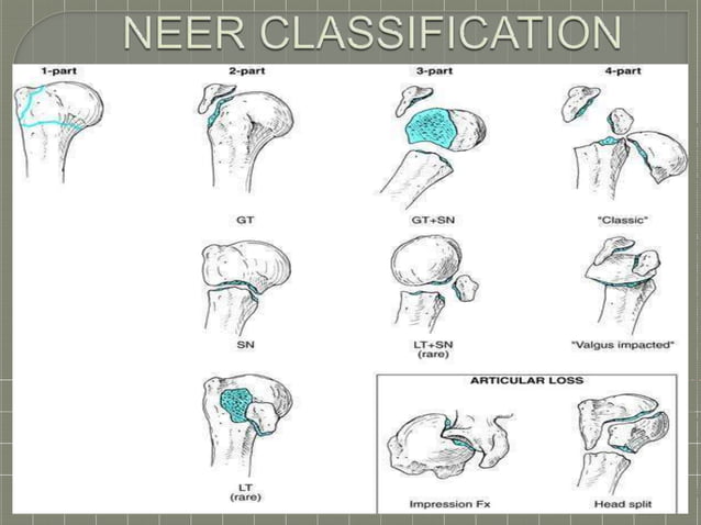 Proximal humerus fractures | PPTX | Death, Injury, or Military Conflict ...