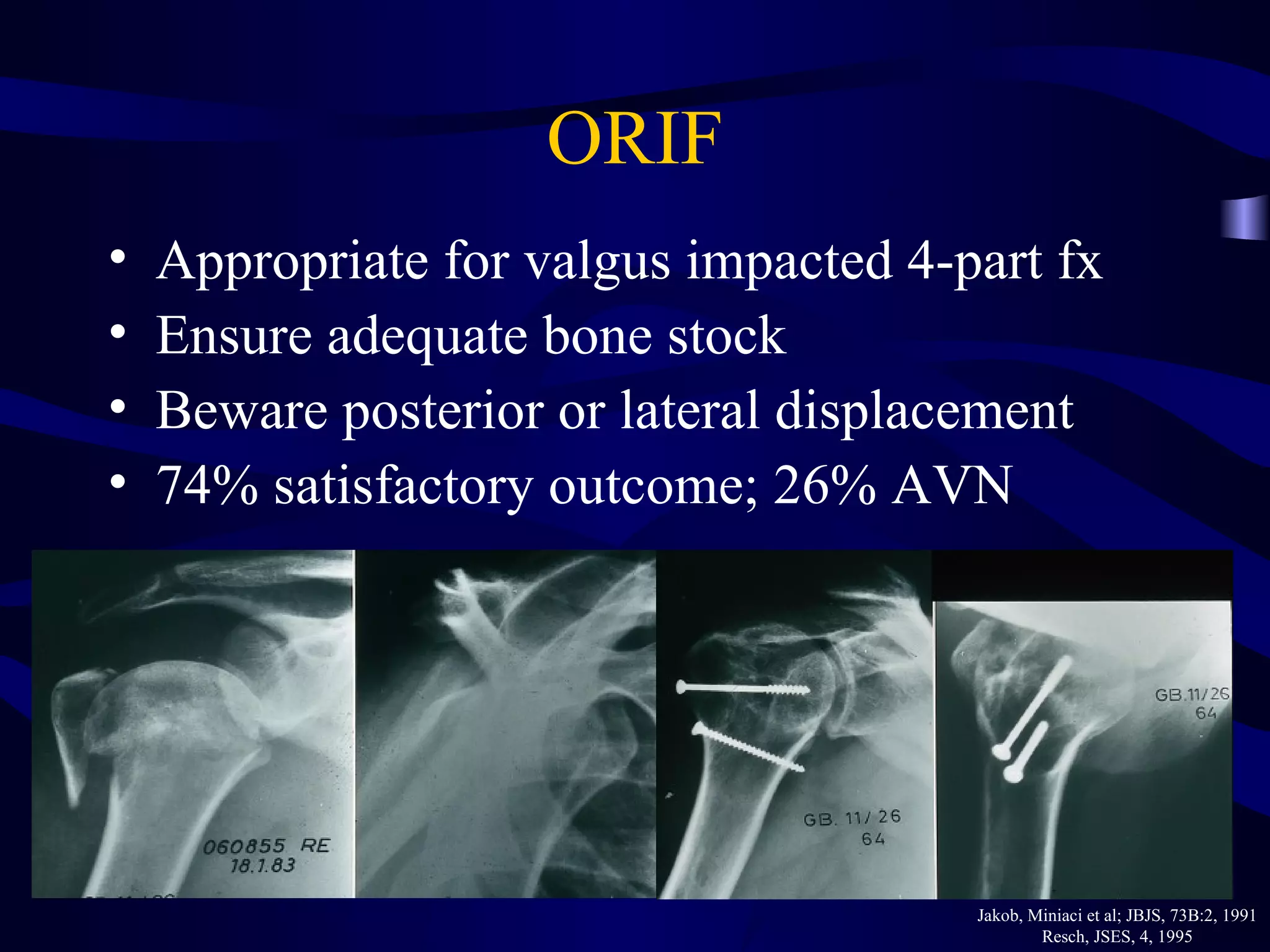 Prox humerus fx for leathers | PPT | Death, Injury, or Military ...