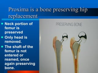 Short Stem Hip Replacement - Proxima hip replacement | PPT