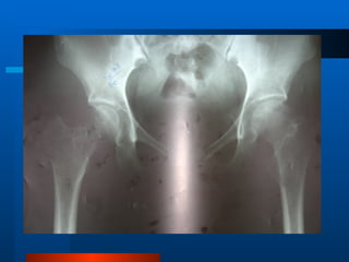 Proxima Hip Replacement | PPT