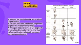 nenenenennenenenenen-humerus-fracture.pptx