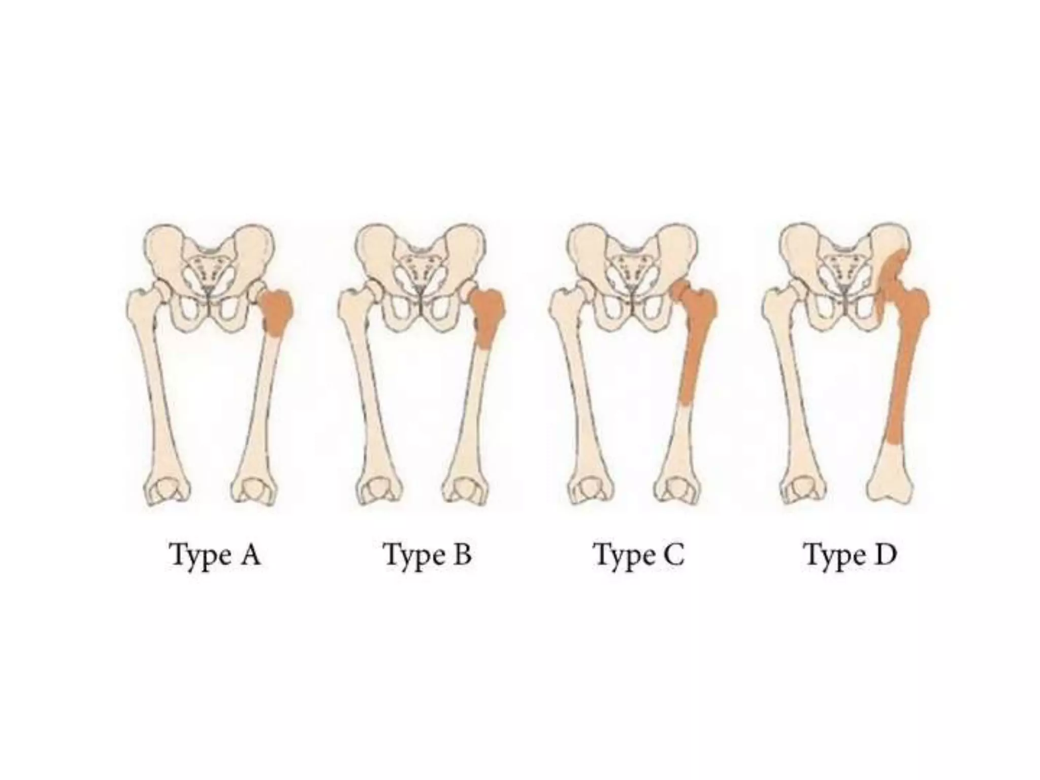 Proximal Femoral Focal Deficiency.pptx