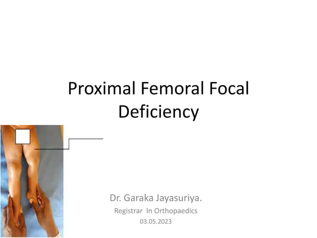 Proximal Femoral Focal Deficiency.pptx | Physical Therapy | Wellness