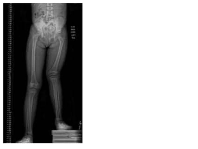 Proximal Femoral Focal Deficiency.pptx | Physical Therapy | Wellness