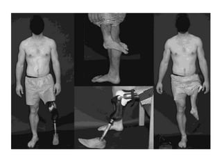 Proximal Femoral Focal Deficiency.pptx | Physical Therapy | Wellness