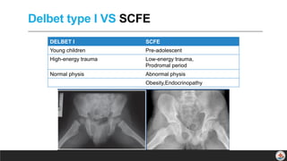 Proximal Femoral Fracture in Ped.pdf