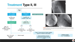 Proximal Femoral Fracture in Ped.pdf