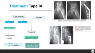Proximal Femoral Fracture in Ped.pdf