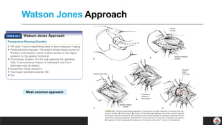 Proximal Femoral Fracture in Ped.pdf